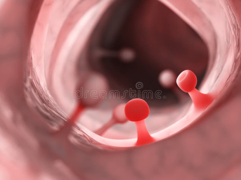 Colon Polyps 3d Illustration Polyp In The Intestine Stock
