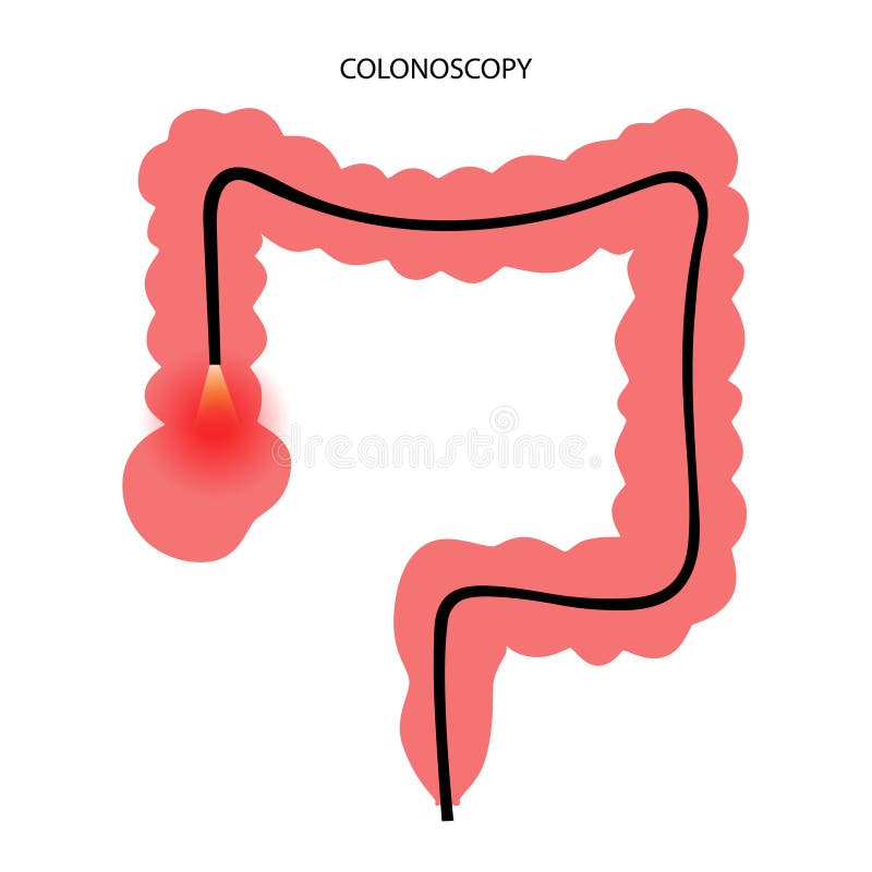 Colonoscopy Procedure Concept Stock Vector - Illustration of intestine ...