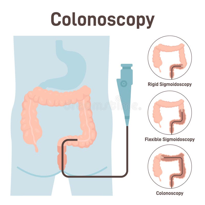 Colonoscopy. Medical Diagnostics of the Large Intestine Stock ...