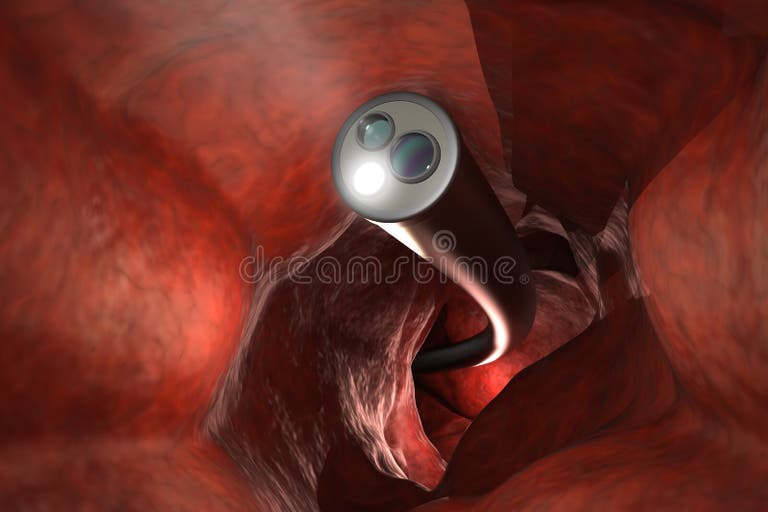 Colonoscopy 3d Stock Illustrations – 331 Colonoscopy 3d Stock ...