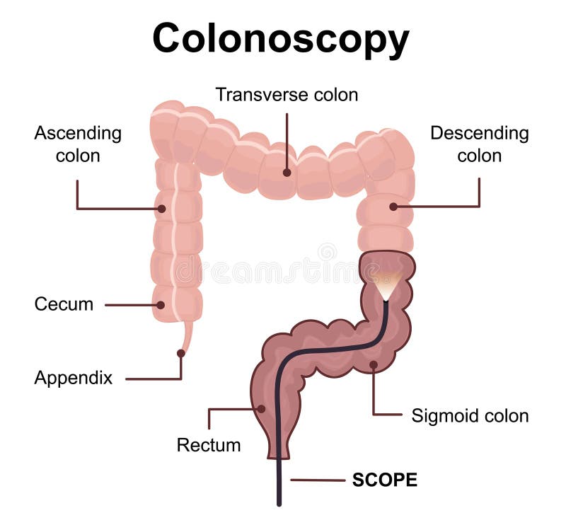 Colonoscopy Technology Concept with Rendering Endoscope Inside of ...