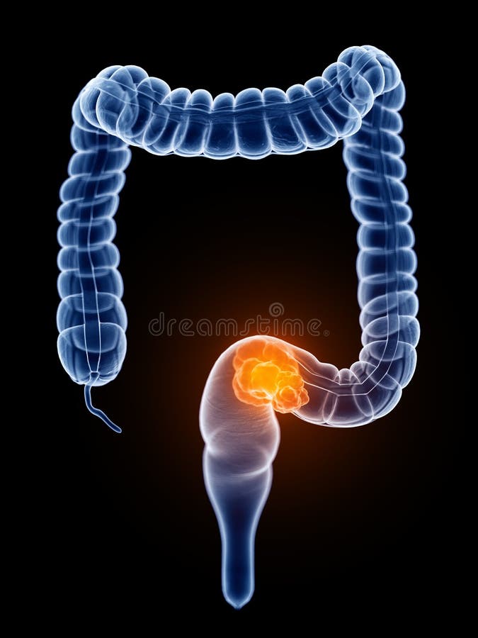 Colorectal cancer stock illustration. Illustration of colorectal - 73538707