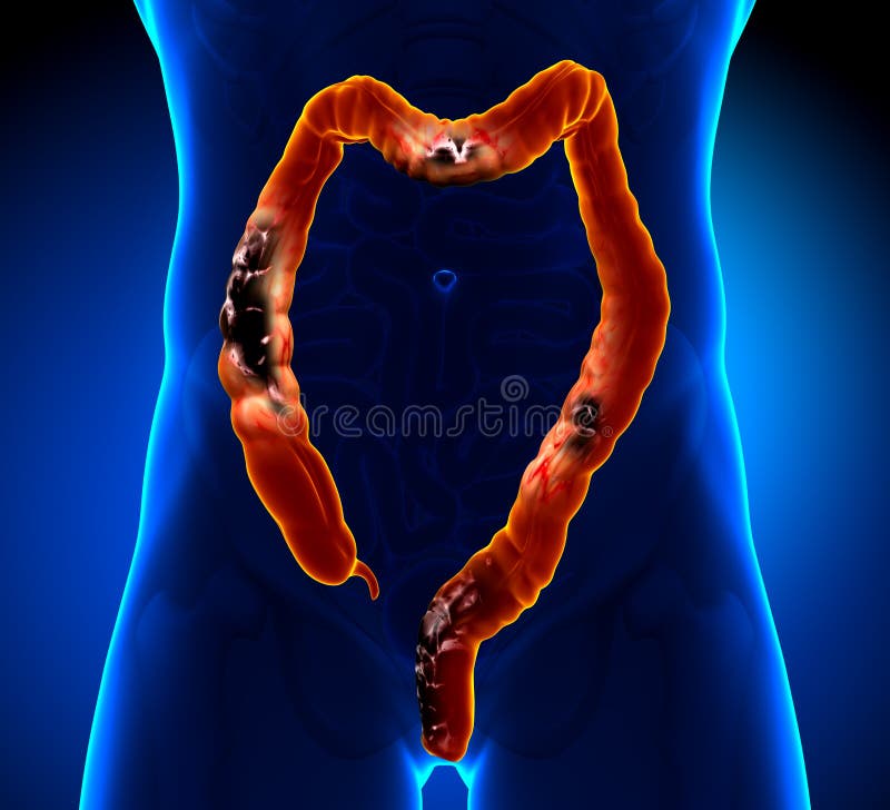 Colorectal Cancer and Polyp Stock Illustration - Illustration of blue ...