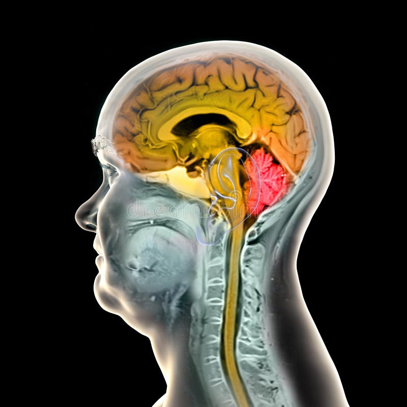 Colored Composite MRI Image and 3D Illustration of the Brain from a 44 ...