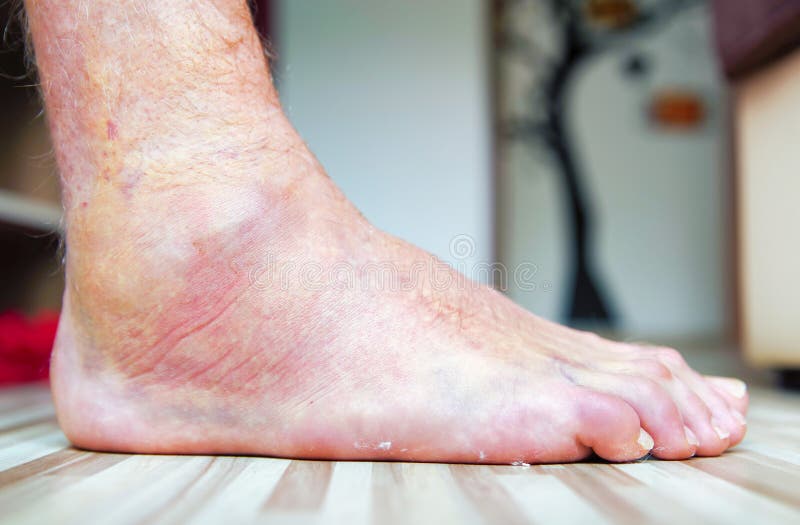 Colorful broken leg stock image. Image of injury, accident - 82046145