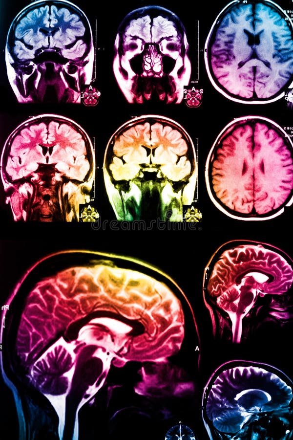 Sharp ct scan stock photo. Image of negative, mental - 19150748