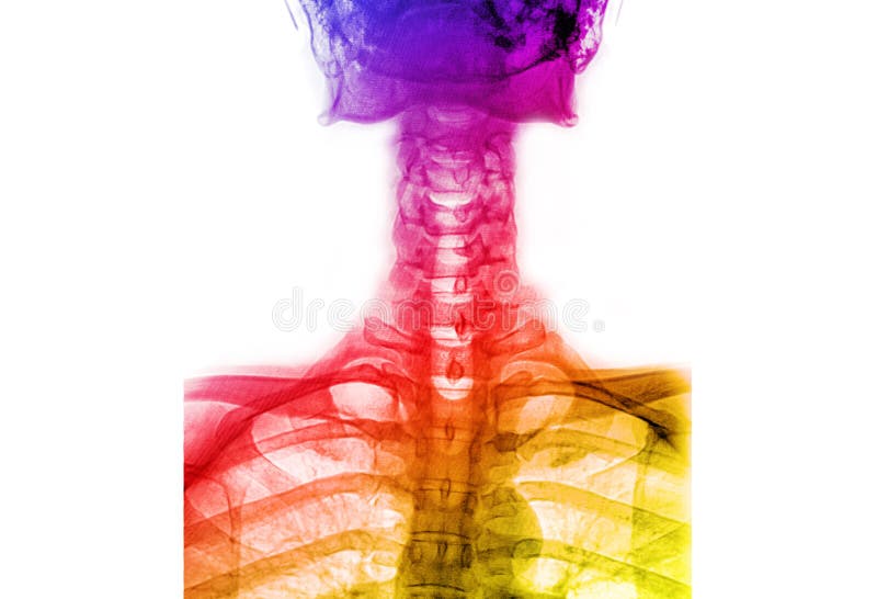Colorful x-ray T-L spine stock image. Image of health - 42597451