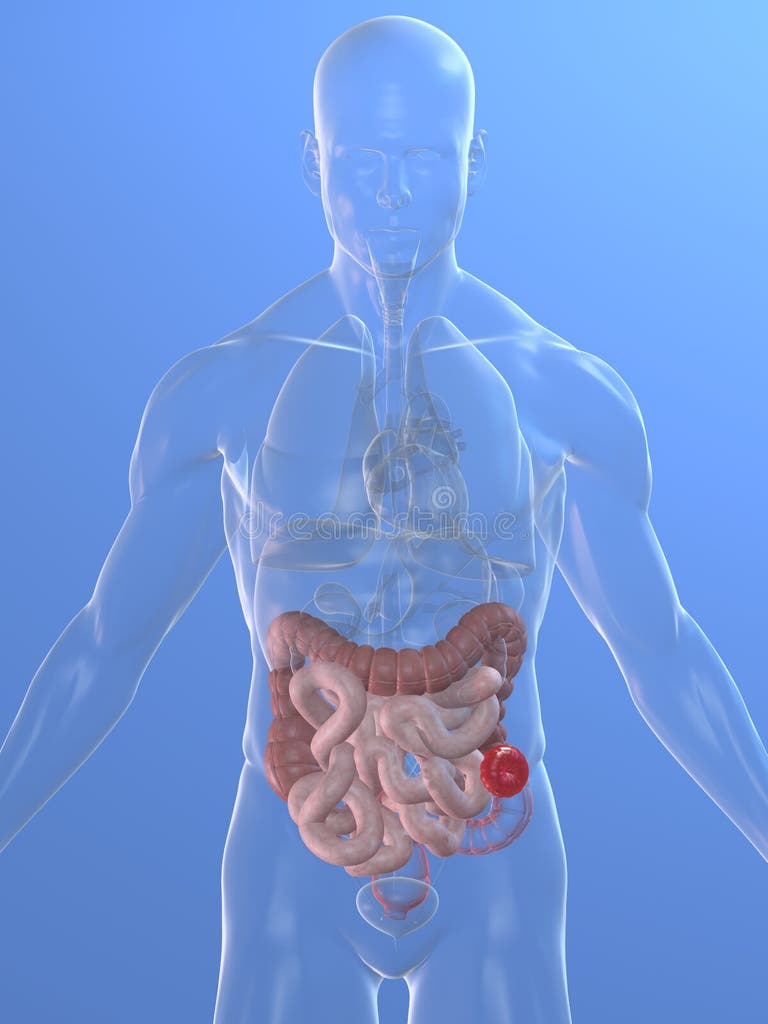 Colostomy Stock Illustrations – 63 Colostomy Stock Illustrations ...