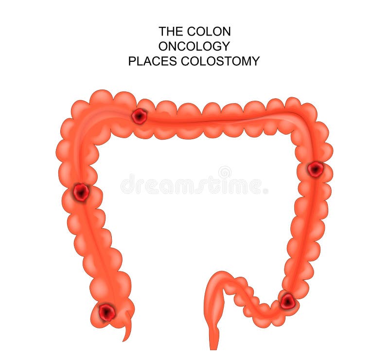 Colostomy. Place Surgical Intervention Stock Vector - Illustration of ...