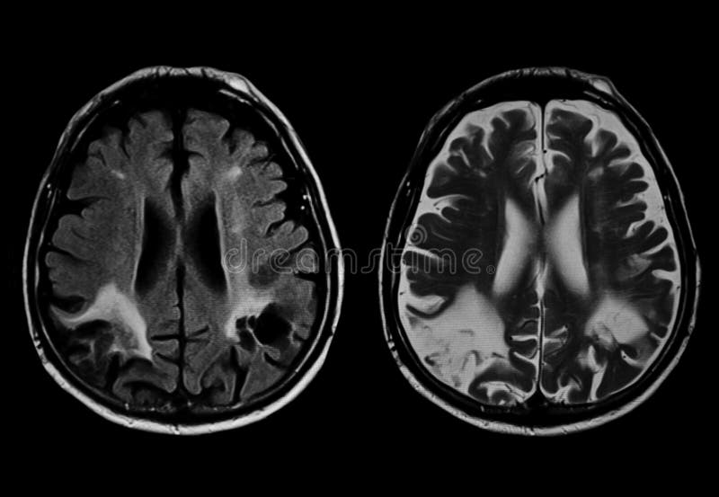 Colpo del cervello immagine stock. Immagine di comune - 32387187