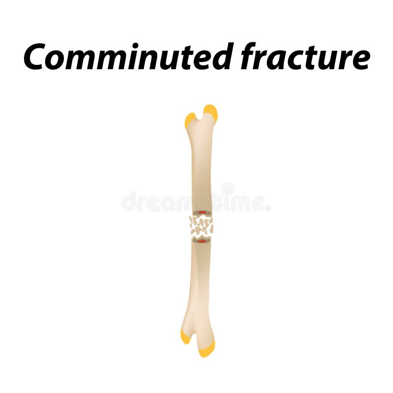 Comminuted Fracture Diagram