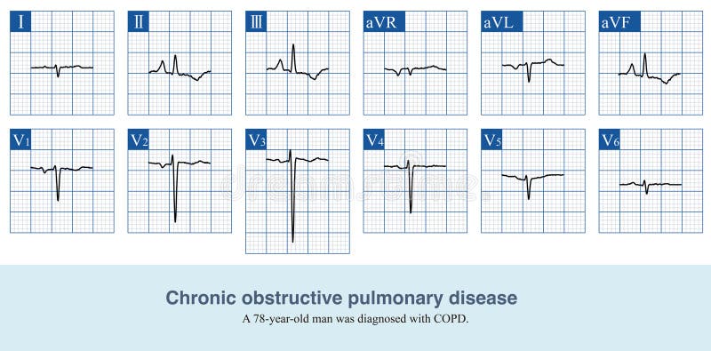Low QRS voltage stock image. Image of education, pulmonary - 386654233