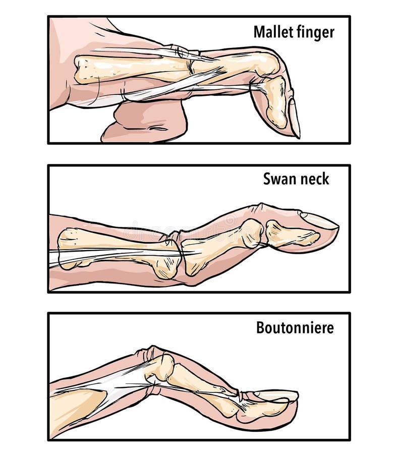 Common Finger Injuries Vector Illustration Stock Vector - Illustration ...