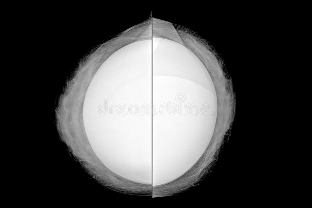 Comparative Mammogram in Caudal-skull Projection Stock Photo - Image of ...
