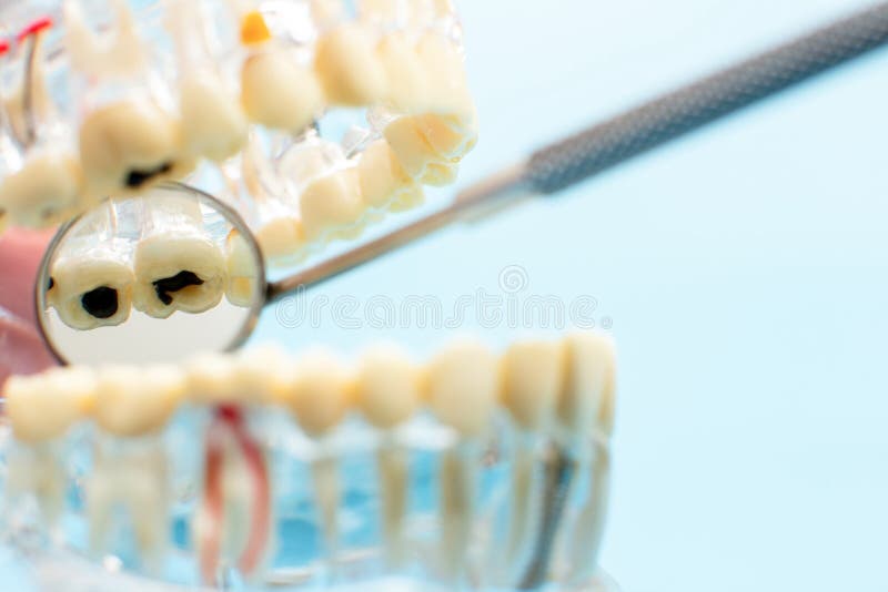 Compare Tooth Model and Tooth Model with Metal Wire Dental Stock Photo ...