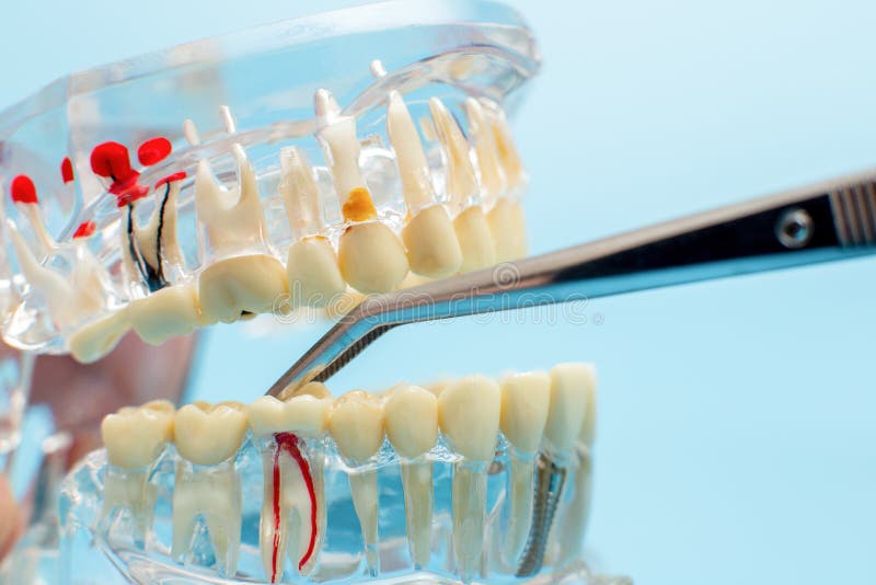 Compare Tooth Model and Tooth Model with Metal Wire Dental Stock Image ...