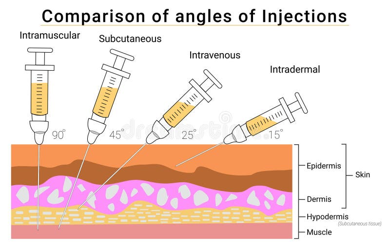 Vector of Comparison of Angles of Injections. Illustration of Injection ...