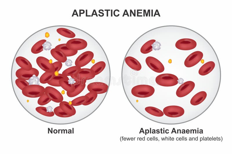 Aplastic Anemia Illustration Stock Illustration - Illustration of text ...
