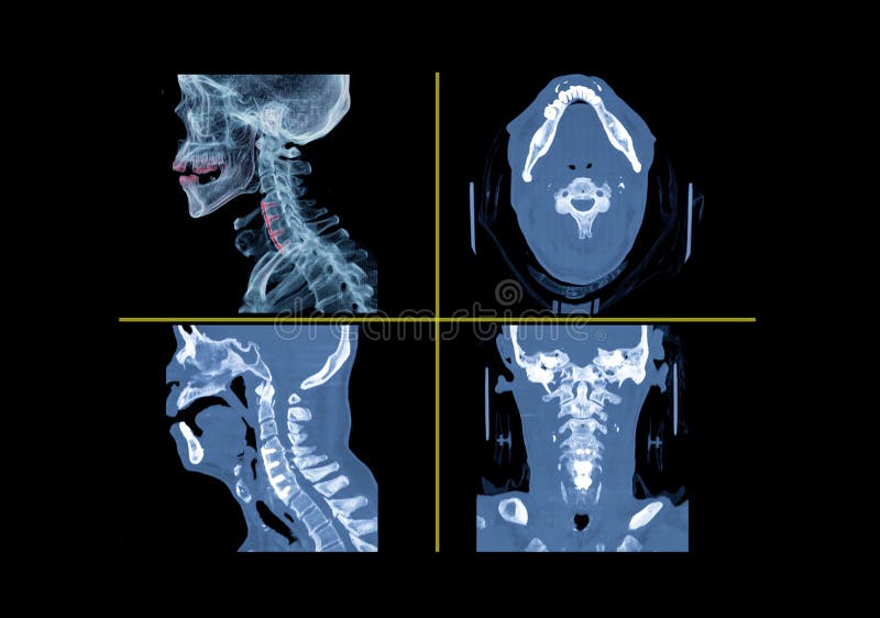 Comparison of CT C-Spine or Cervical Spine 3D Rendering Image . Stock ...
