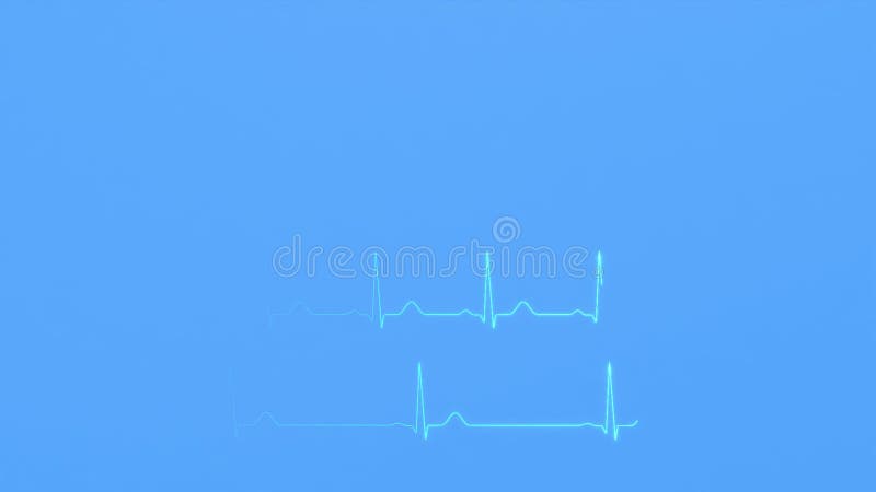 ECG Graphs Comparison of Normal Heart Rhythm and Arrhythmia Stock Video ...