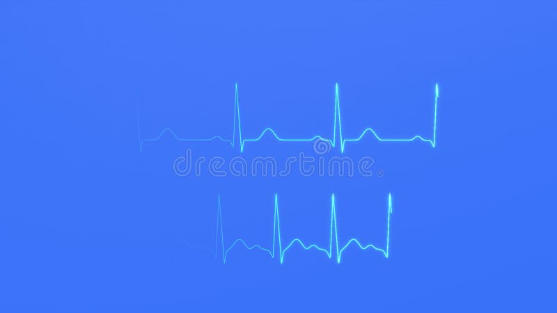 ECG Graphs Comparison of Normal Heart Rhythm and Arrhythmia Stock Video ...