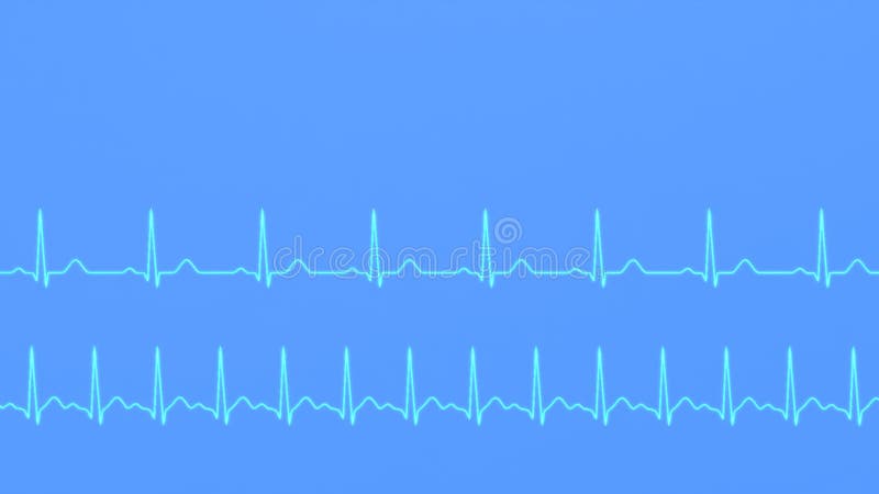 Comparison of ECG of Normal Heart Rhythm and Tachycardia. Stock Photo ...