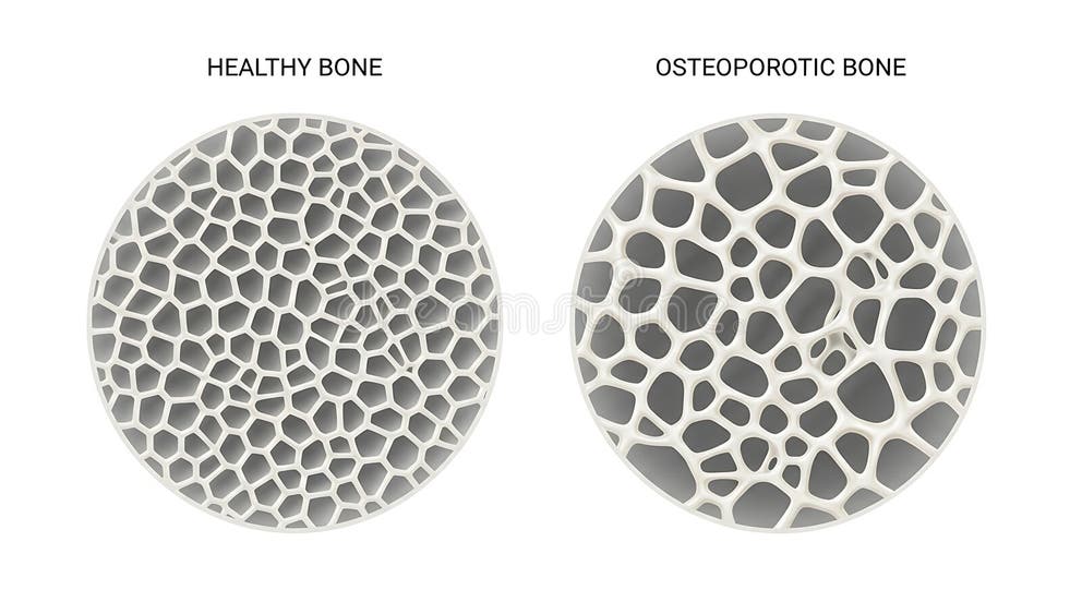 Osteoporotic Bone Structure Stock Illustrations – 92 Osteoporotic Bone ...