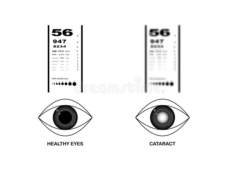 Comparison of Healthy Eyes and Cataract Eyes Vision on Eye Examination ...