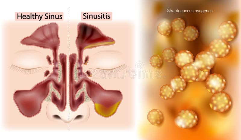 Comparison of Healthy Sinus and Sinusitis with Streptococcus Pyogenes ...