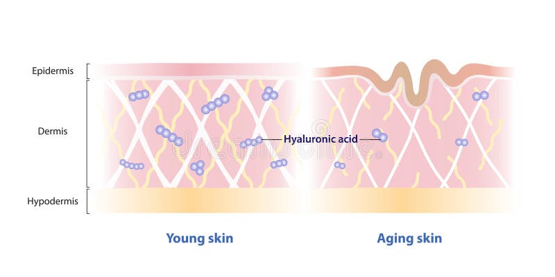 Comparison of Hyaluronic Acid Levels Decrease with Age in Dermis Vector ...