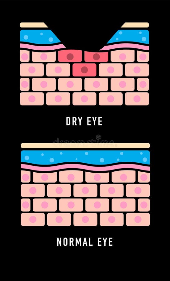 Comparison Illustration between Normal and Dry Eye Stock Vector ...