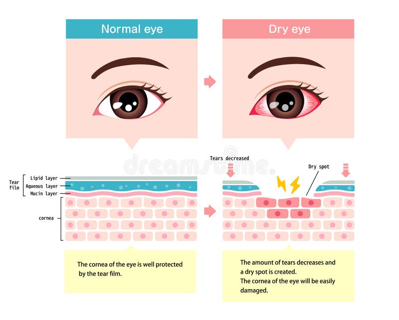 Comparison Illustration between Normal and Dry Eye. Cross Section of ...