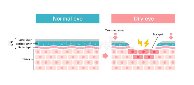 Comparison Illustration between Normal and Dry Eye. Cross Section of ...