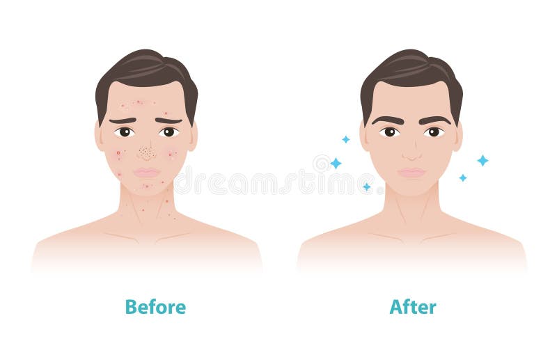 Cartoon Pimple Stock Illustrations – 1,761 Cartoon Pimple Stock ...