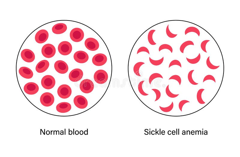 Anemia. Comparison of a Drop of Blood with Normal and Anemic Blood ...