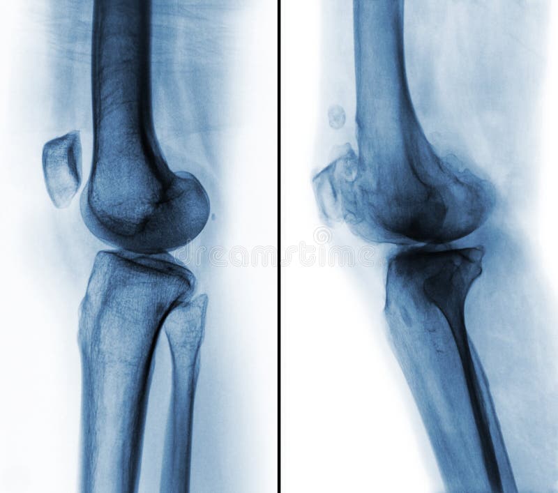 Comparison between Normal Human Knee & X28; Left Image & X29; and ...