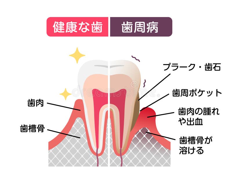 Comparison of Normal Teeth and Periodontal Disease. Flat Vector ...
