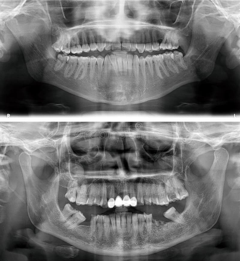 Comparison between a Panoramic X-ray Image of Teeth of an Healthy Teeth ...