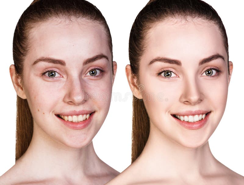 Comparison. Portrait of Beautiful Woman with Problem and Clean Skin ...