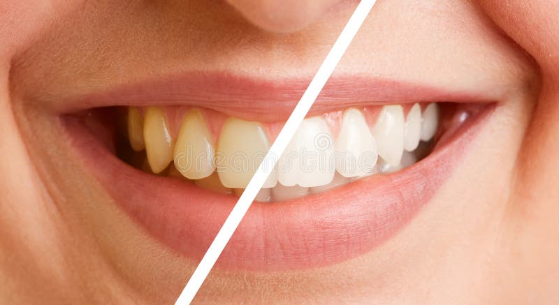 Dirty Clean Tooth Comparison Stock Image - Image of dentistry, enamel ...