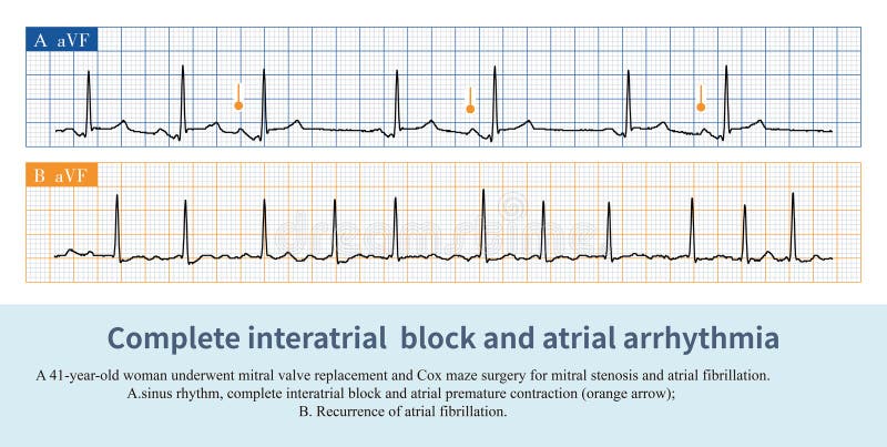 Ecg Characteristics Stock Illustrations – 4 Ecg Characteristics Stock ...