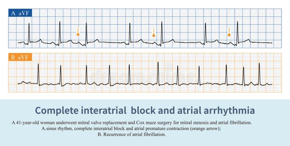 Complete Interatrial Block and Atrial Arrhythmia Stock Illustration ...