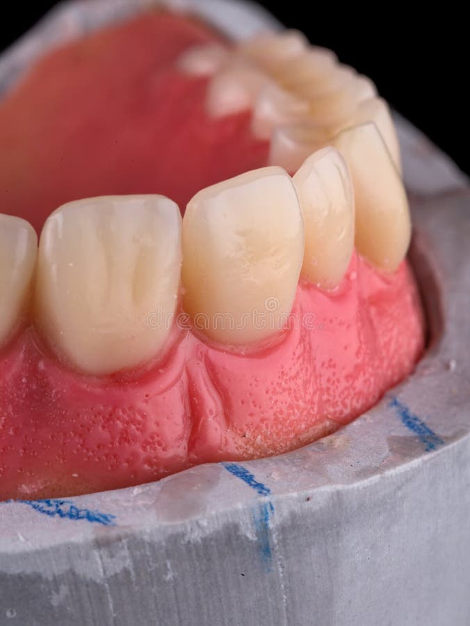 Complete Maxillary Denture â€“ Wax-Up and Gingival Contouring Stock ...