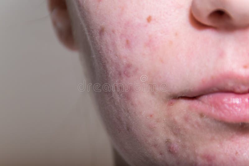 Complex Acne Problems, Red Pimples, Problematic Dry Skin Woman Stock ...