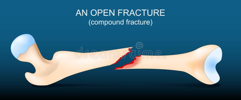Compound Fracture of Human Femur Bone Stock Vector - Illustration of ...