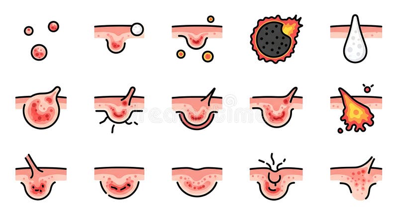 Skin Problems and Acne Types Icon Set Stock Vector - Illustration of ...