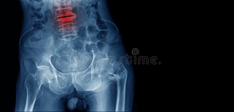 Compression fracture stock image. Image of injury, hospital - 116891455