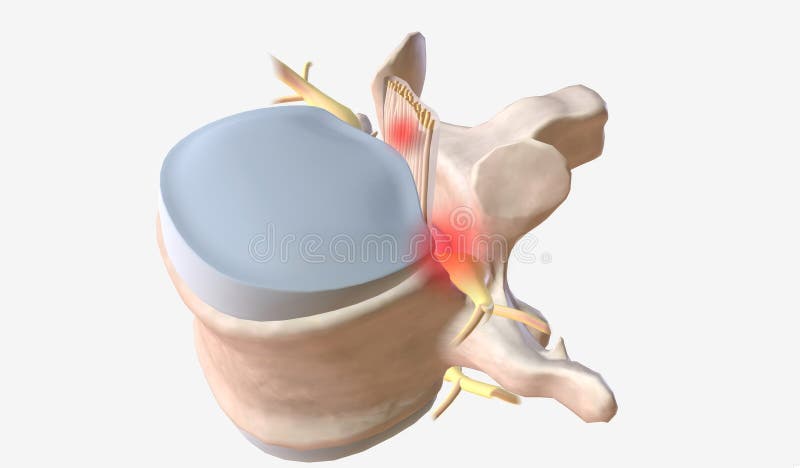 Spinal Cord Compression Stock Illustrations – 91 Spinal Cord ...