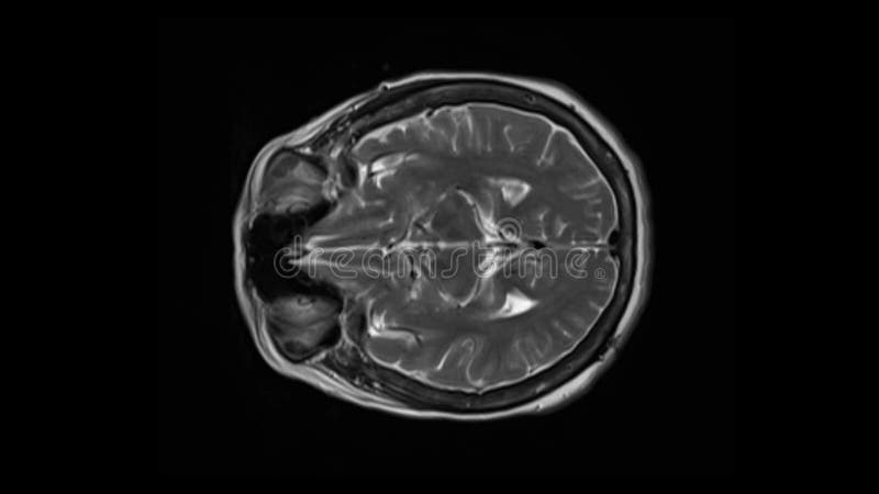 Human Brain Scan Mri Brain Scan Computed Tomography Of The Human Brain Stock Video Video Of