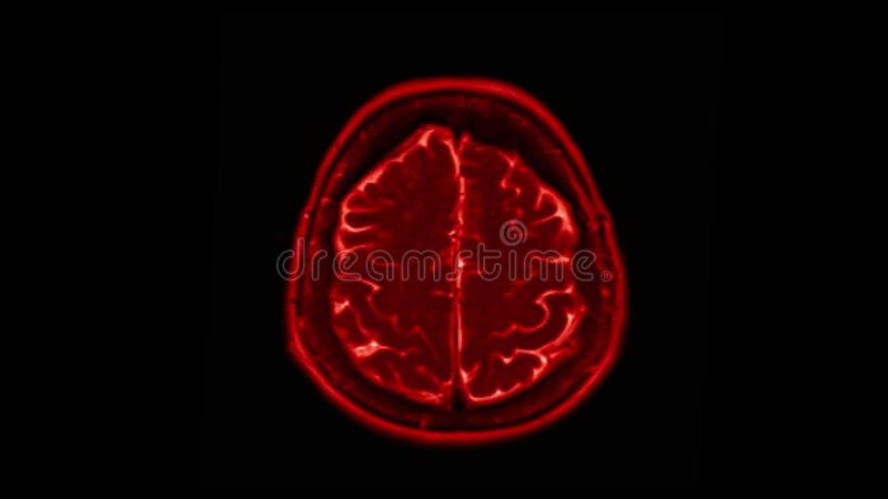 Human Brain Scan Mri Brain Scan Computed Tomography Of The Human Brain Stock Video Video Of